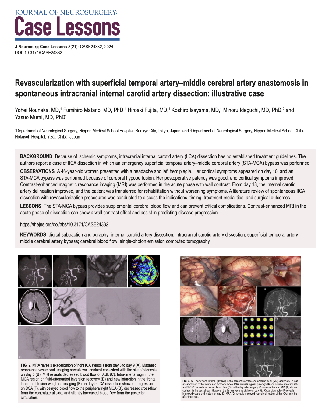 大学院生 能中陽平先生の論文が JNS Case lessons に掲載 ｜ 日本医科大学 脳神経外科学教室
